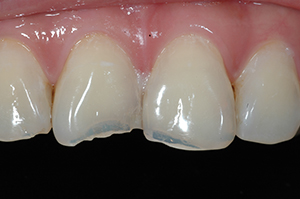 Composite restorations